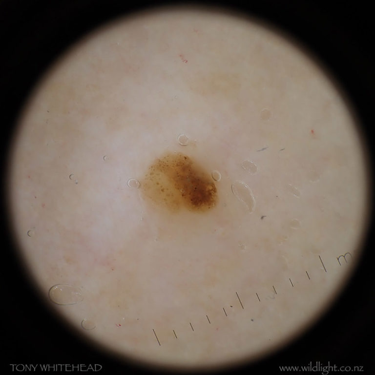 Skin Lesion Photography - WildLight Photography